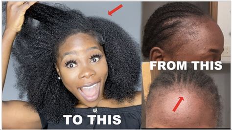 HOW TO REGROW YOUR EDGES HAIRLINE BACK FAST 2 PRODUCTS YOU NEED
