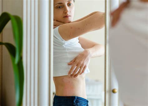 Atopijski dermatitis olakšajte simptome ekcema