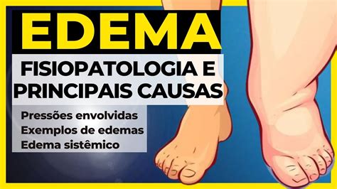 Quais São As Principais Causas Do Edema Cerebral LIBRAIN