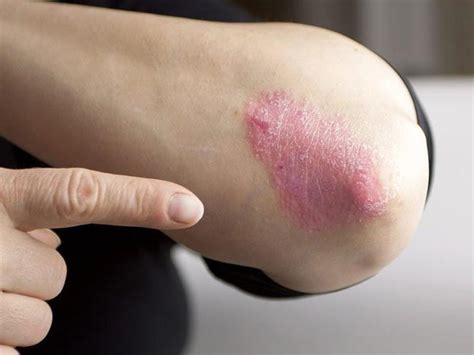 Sedef hastalığı Psoriasis nedir Sedef hastalığının nedenleri