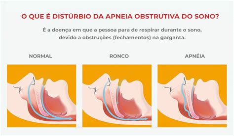 O Ronco E A Apneia Obstrutiva Do Sono Sominus