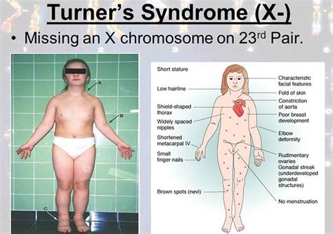 Síndrome de Turner O que é causas sintomas tratamento