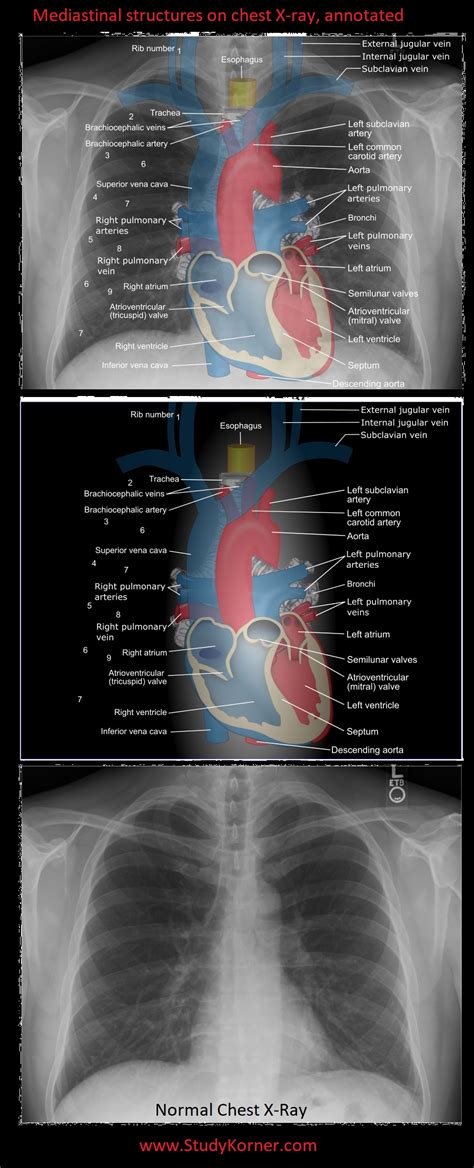 Lateral Chest X Ray Anatomy