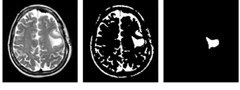 figure 4 from a hybrid cnn svm threshold segmentation approach for tumor detection and
