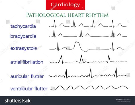 Colección patológica de ecg Ilustración vectorial vector de stock