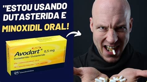 USO DUTASTERIDA E MINOXIDIL ORAL PARA TRATAR MINHA CALVÍCIE YouTube