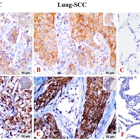 Expression Of Pd L And Hif Protein In Lung Adc Lung Scc And