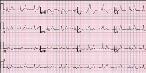 Bundle Branch Block Causes Symptoms Diagnosis Treatment