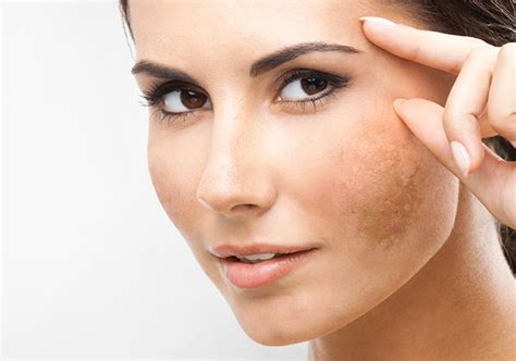 Pete Maronii Pe Piele Remedii Naturale Pentru Prevenire Si Combatere