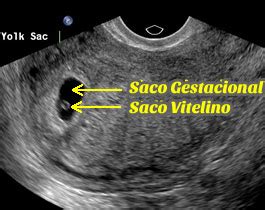 O que é saco gestacional Almanaque dos Pais