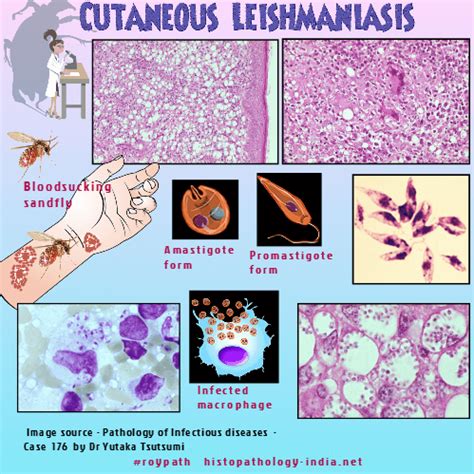 Cutaneous Leishmaniasis Histology