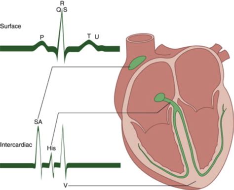 Supraventricular Arrhythmias Part 1 Flashcards Quizlet