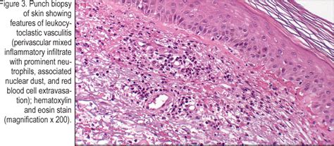 Leukocytoclastic Vasculitis