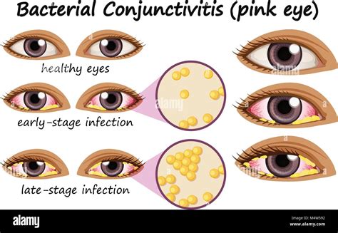Viral Conjunctivitis Vs Bacterial