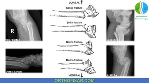 Colles Fracture Classification