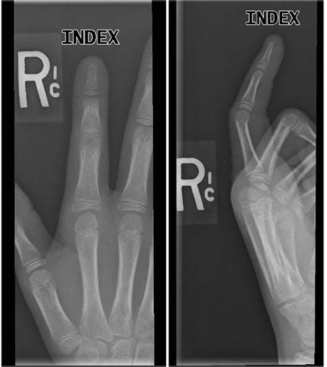 Dislocated Index Finger