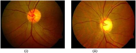 figure 2 from fuzzy clustering based glaucoma detection using the cdr semantic scholar