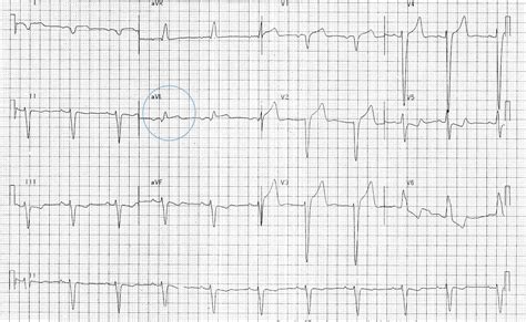 Sgarbossa Criteria Litfl Ecg Library Diagnosis