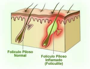 Foliculite o que é tipos causas sintomas tratamento verloop io