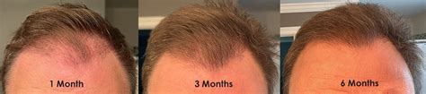 6 Month Hair Transplant Transition Hair Restoration Center Of CT