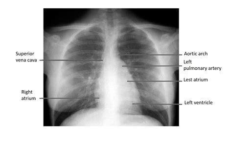 X Ray Chest Heart
