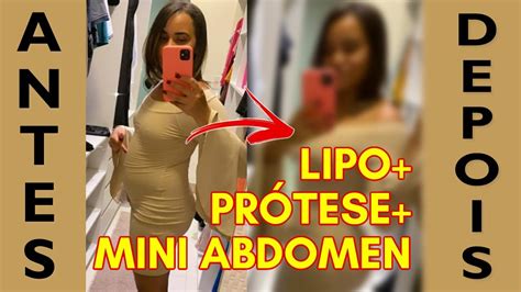 Antes E Depois Lipo Mini Abdominoplastia Pr Tese Youtube