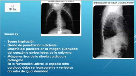 Radiografia De Torax Uakine Aprende A Interpretar Una Radiografia