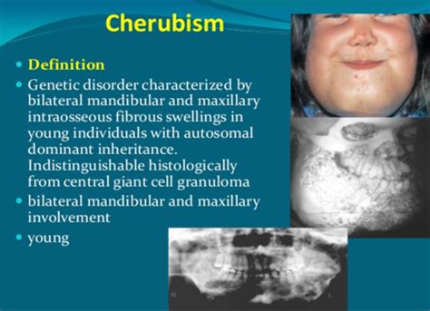Pathology Chapter Non Neoplastic Diseases Of Bone Flashcards