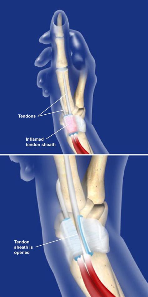 De Quervains Release Orthopaedic Associates Of Riverside