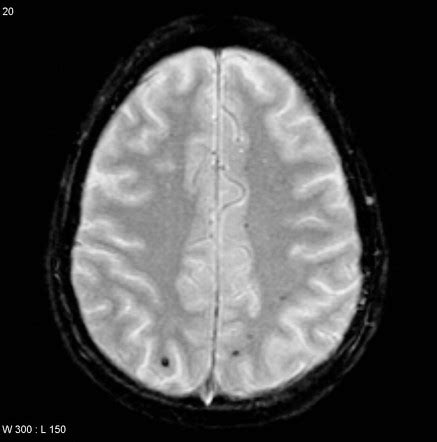 Diffuse Axonal Injury Grading Radiology Reference Article
