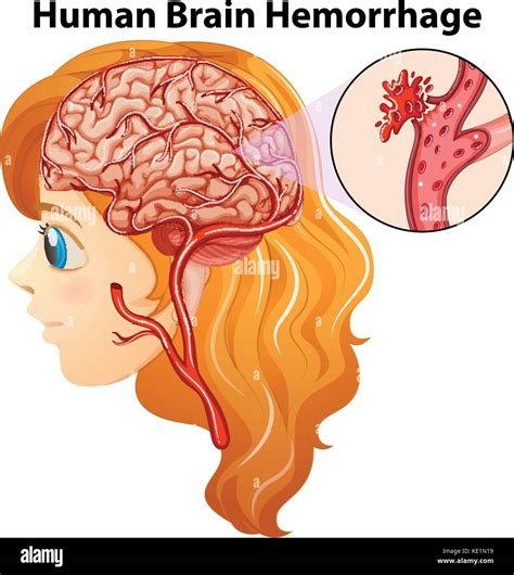 Diagrama Que Muestra Hemorragia Cerebral Humana The Best Porn Website