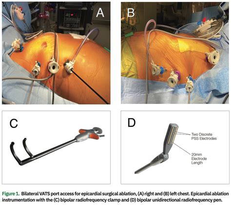 Hybrid Ablation For A Patient With Persistent Atrial Fibrillation And