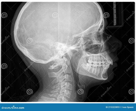 X Ray Of The Skull Bones In Lateral View Stock Image Image Of Health