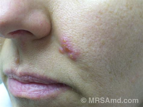 Early Mrsa Rash