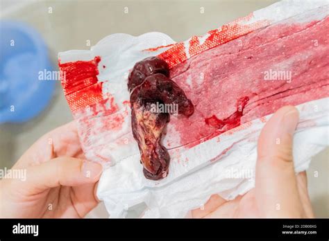 La sangre del aborto espontáneo en la servilleta mostrando el signo del