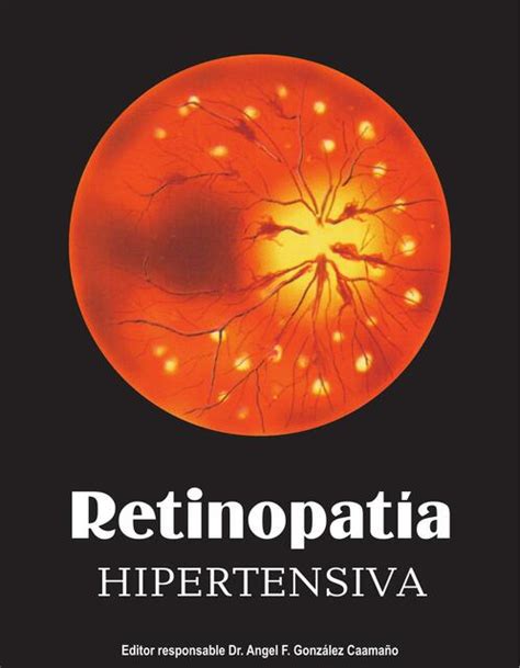 Resúmenes de Retinopatía hipertensiva Descarga apuntes de Retinopatía