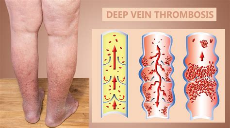 Chronic Venous Insufficiency Signs Symptoms Complications Pedes