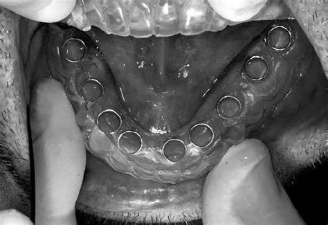 Planificacion De Tratamiento Con Software Para Cirug A Guiada En