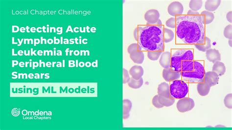 acute lymphoblastic leukemia all detection using deep learning models from pbs images youtube