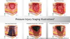 Staging Grading Of Pressure Ulcers Harvest Healthcare