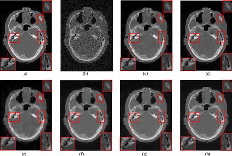 denoising results for one slice 98 of the 3 d medical image download scientific diagram