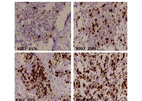 Ki67 Expression In Breast Cancer By Immunohistochemistry Brown Nuclear