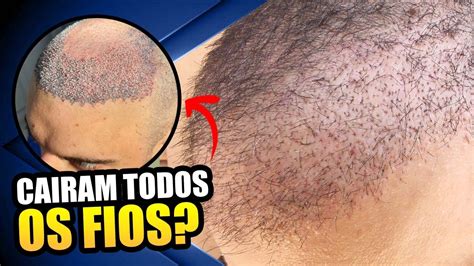 Transplante Capilar Dias Depois Da Cirurgia Youtube