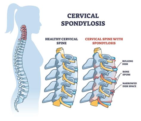 Information On Artificial Cervical Disc Replacement Anterior Cervical