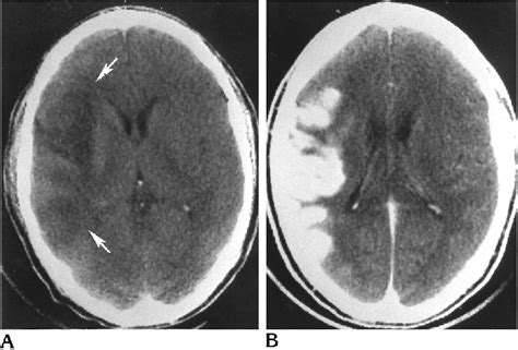 Figure 1 From Neurosyphilis In HIV Positive And HIV Negative Patients
