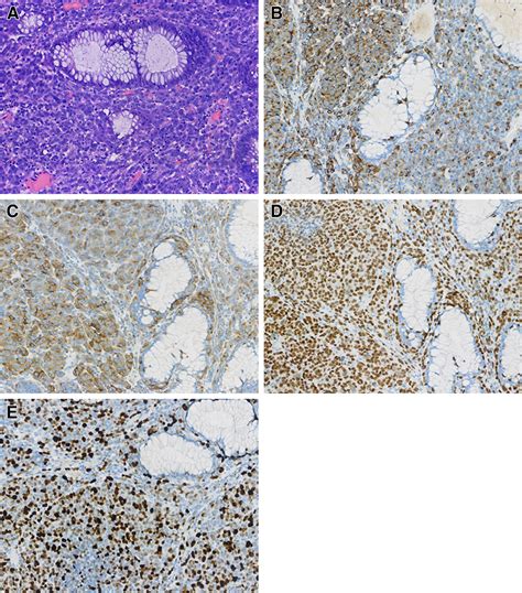 Primary Malignant Anorectal Melanoma Journal Of Gastrointestinal Surgery