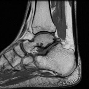 Basic Ankle Mri