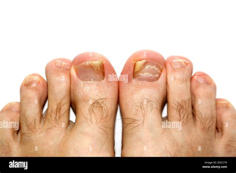 Onicomicosis Dermatofitos Infecci N Por Hongos En Las U As De Los Pies