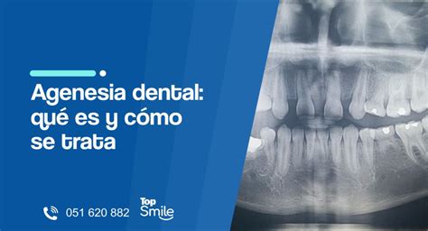 Agenesia dental qué es y cómo se trata