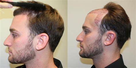 Wie mache ich eine Haartransplantation Schritt für Schritt